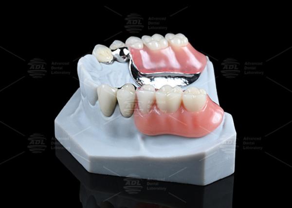 Quality Silver Key And Keyway Attachment Easy Maintenance Precision Attachment Dental for sale