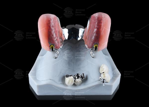 Quality Silver Key And Keyway Attachment Easy Maintenance Precision Attachment Dental for sale