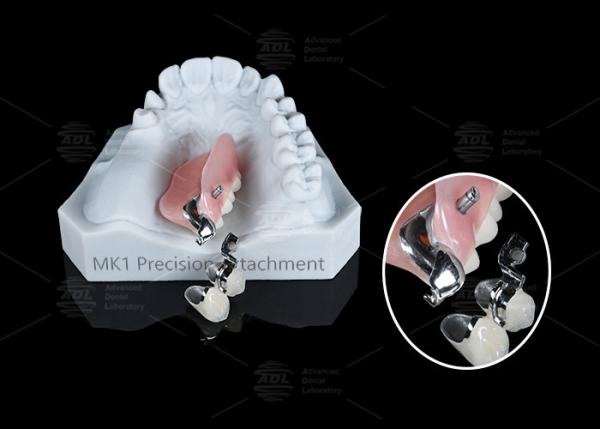 Quality MK1 Attachment Dental Prosthesis Silver Partial Denture Precision Attachments for sale