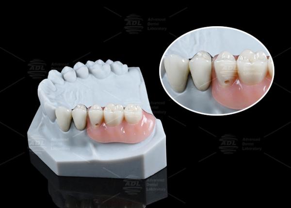 Quality MK1 Attachment Dental Prosthesis Silver Partial Denture Precision Attachments for sale