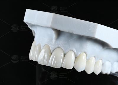 China China Dental Lab High Esthetics Translucency EMAX Veneer with 0.3-0.5mm Thickness for Anterior and Posterior Restorations for sale