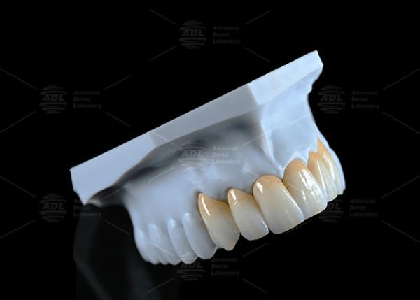 Quality High Translucency Full Contour Zirconia Bridge Chipping Resistance Natural for sale