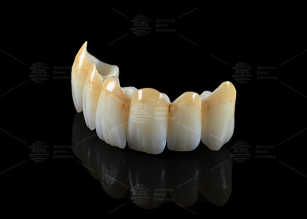 Quality High Translucency Full Contour Zirconia Bridge Chipping Resistance Natural for sale