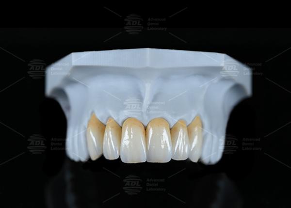 Quality High Translucency Full Contour Zirconia Bridge Chipping Resistance Natural for sale