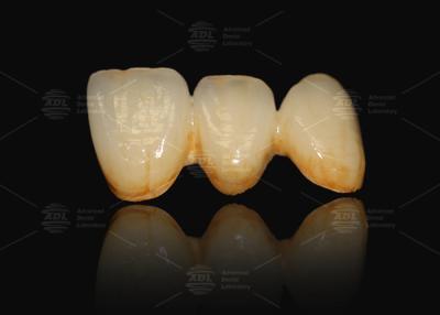 A3 A3.5 Porcelain Fused To Metal Co Cr And Ceramic Dental Crown PFM Cad Cam