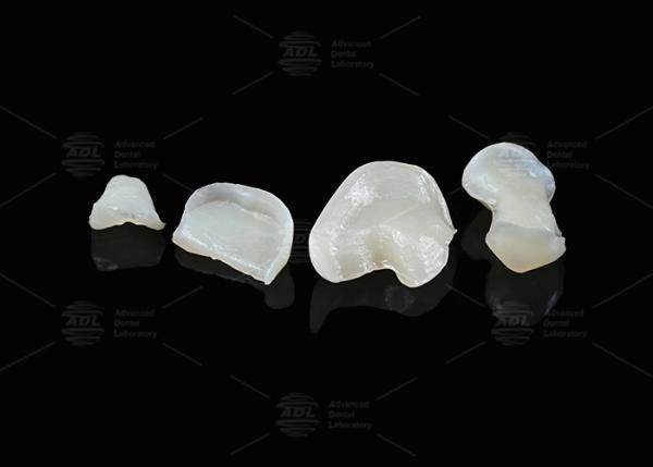Quality Translucent Onlay Zirconia Inlay For Long Lasting Stain And Wear Resistance for sale