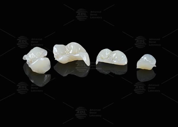 Quality Translucent Onlay Zirconia Inlay For Long Lasting Stain And Wear Resistance for sale