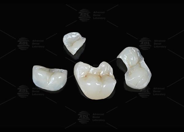 Quality Translucent Onlay Zirconia Inlay For Long Lasting Stain And Wear Resistance for sale