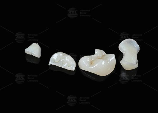 Quality Translucent Onlay Zirconia Inlay For Long Lasting Stain And Wear Resistance for sale