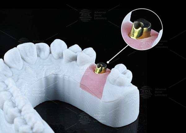 Quality Customized Titanium Base Corrosion Resistance Dental Implants And Solutions for sale