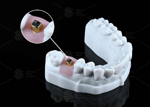 Quality Customized Titanium Base Corrosion Resistance Dental Implants And Solutions for sale