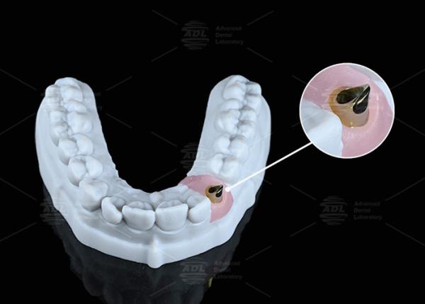 Quality Universal Angled Screw Channel Compatible With Cad / Cam Systems for sale