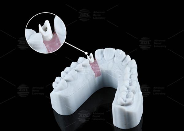Quality White Custom Zirconia Abutment Natural Looking Aesthetics And Optimal Functional for sale