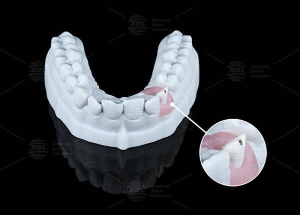 Quality White Custom Zirconia Abutment Natural Looking Aesthetics And Optimal Functional for sale