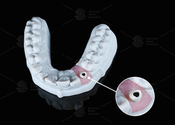 Quality White Custom Zirconia Abutment Natural Looking Aesthetics And Optimal Functional for sale