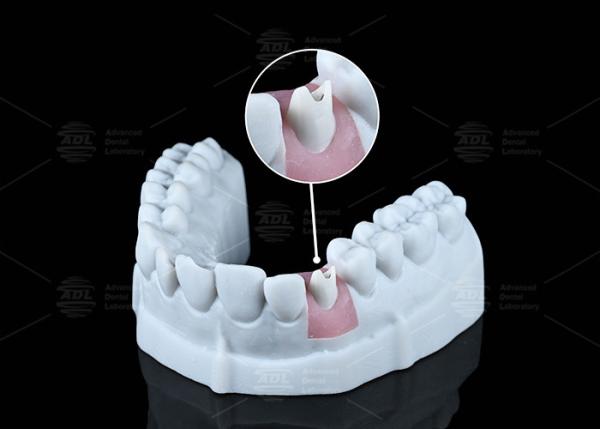 Quality White Custom Zirconia Abutment Natural Looking Aesthetics And Optimal Functional for sale