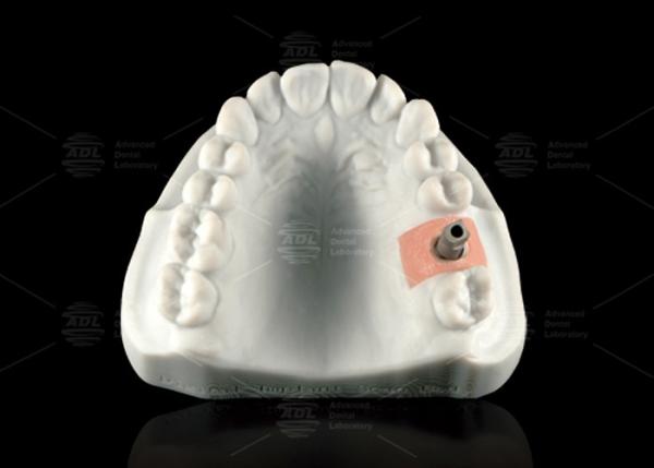 Quality Precision Titanium Digital Implant Scan Body Sandblasted Surface For Cad/Cam for sale