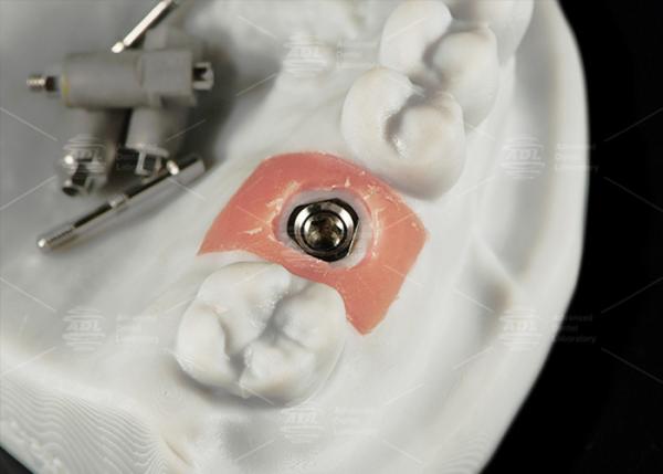 Quality Precision Titanium Digital Implant Scan Body Sandblasted Surface For Cad/Cam for sale