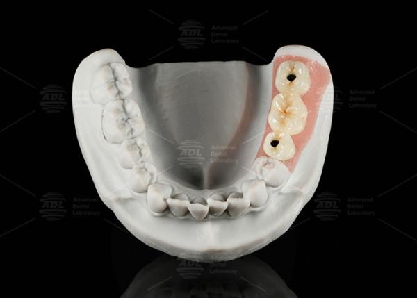 Quality Screw Retained Titanium Custom Abutment Porcelain Fused To Zirconia for sale