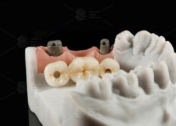 Quality Screw Retained Titanium Custom Abutment Porcelain Fused To Zirconia for sale