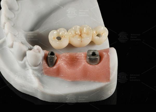 Quality Screw Retained Titanium Custom Abutment Porcelain Fused To Zirconia for sale