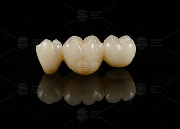 Quality Screw Retained Titanium Custom Abutment Porcelain Fused To Zirconia for sale
