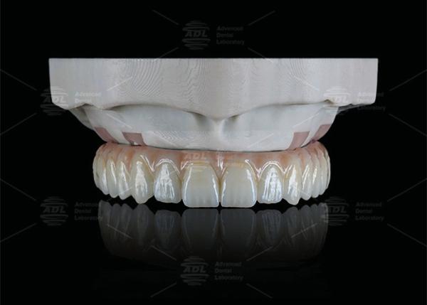Quality Translucent Full Contour Zirconia Bridge Over Milled Implant Bar Customized for sale