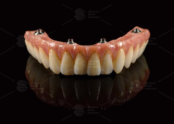 Quality Composite Pink Porcelain Crown A1 Shade All On 4 Hybrid Titanium Screw Retained for sale