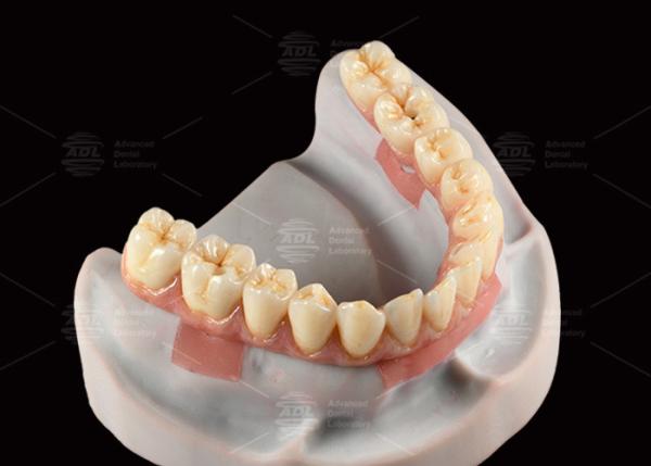 Quality Composite Pink Porcelain Crown A1 Shade All On 4 Hybrid Titanium Screw Retained for sale