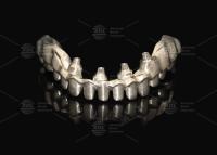 Quality Hybrid Pink Porcelain Implant Crown Malong Full Arch Implant Bridge Immediate manufacturer