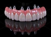 Quality China Dental Lab Titanium Screw Retained Malong Design A1 Shade Full Arch Hybrid for sale