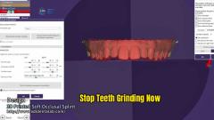 Custom 3D Printed Splint for Bruxism Comfort
