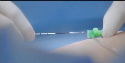 Cina Chirurgia lipolisi lifting del viso endolaser fibra nuda evlt fibra radiale fibra emorroidi fistola in vendita