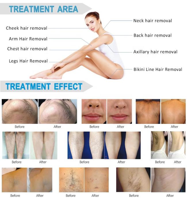 Diode Laser Hair Removal 755 808 1064 nm Laser Tattoo Removal Medical Beauty Equipment