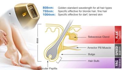 중국 독일에서 수입된 팔라디움 막대기 다이오드 레이저 탈모 기계 점 크기 15*15mm 판매용