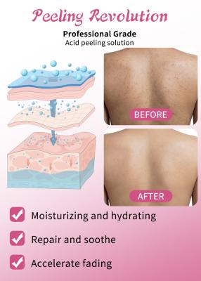 Cina Sero esfoliante Soluzione di peeling della pelle Eliminatore di acne Cura della pelle Peeling 30 ml in vendita