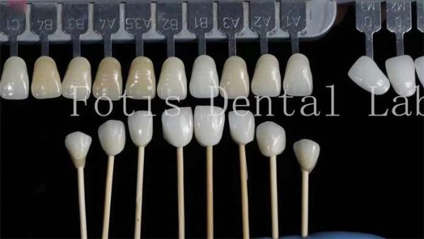 Quality Customization Natural Dental Veneers Fake Teeth Overlays High Strength for sale