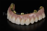 China Full Arch All on 6 Dental Implants Minimally Invasive Same Day Teeth Solution for sale