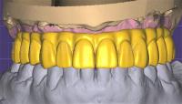 China Dental Design 3Shape Crown Software for Jaw Reconstruction and Implant Planning for sale