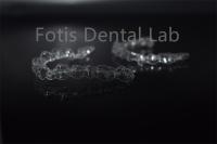 China Custom Removable Clear Invisible Aligner Dental Braces 6-18 Months Treatment for sale