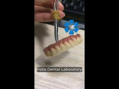 Zirconia All-on-4 Implantatieprocedure Zelfde dag Herstel Minimale follow-up nodig