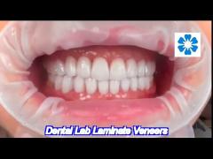 Goedkope tandheelkundige hyrax expander orthodontische retainer gemakkelijk te reinigen en onderhouden