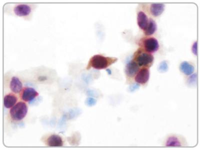 Cina Prova di dosagggio immunologico dello screening del cancro cervicale ICC CE p16/Ki-67 di Kit Cap Asccp in vendita