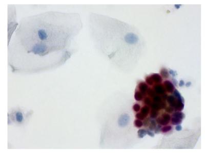 China Biomarkers poderosos IHC do Immunoassay que mancham Kit For Cervical Cancer Screening à venda