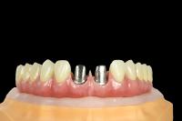 Quality FDA Titanium Bridge Dental Implant Titanium Framework With Crown for sale