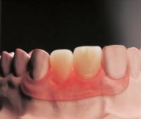 China Flexible Flipper Removable Dentures Clinical Removable Partial Prosthodontics for sale