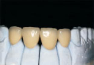 China Metallic / Natural Ti Base Crown Post Core Titanium Crowns For Teeth for sale