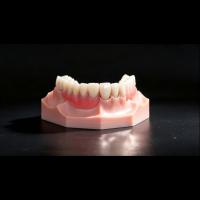 China Metal Framework Precision Attachment Overdenture Removable Tooth Denture for sale
