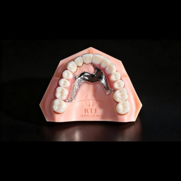 Quality Metal Framework Precision Attachment Overdenture Removable Tooth Denture for sale