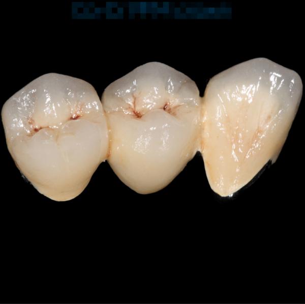 Quality Post Core Non Precious Metal Crown And Bridge Strong Strength Customizable for sale